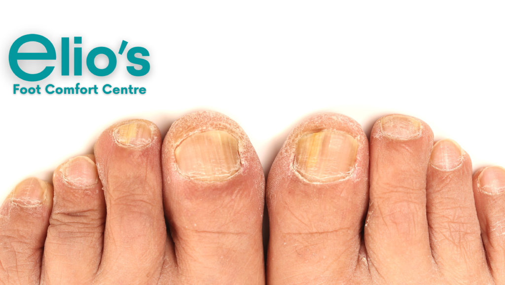 Fungal Nail Infections · Elio's Foot Comfort Centre